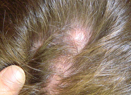 Grützbeutel Abbildungen Atherom | YUVEO Klinik