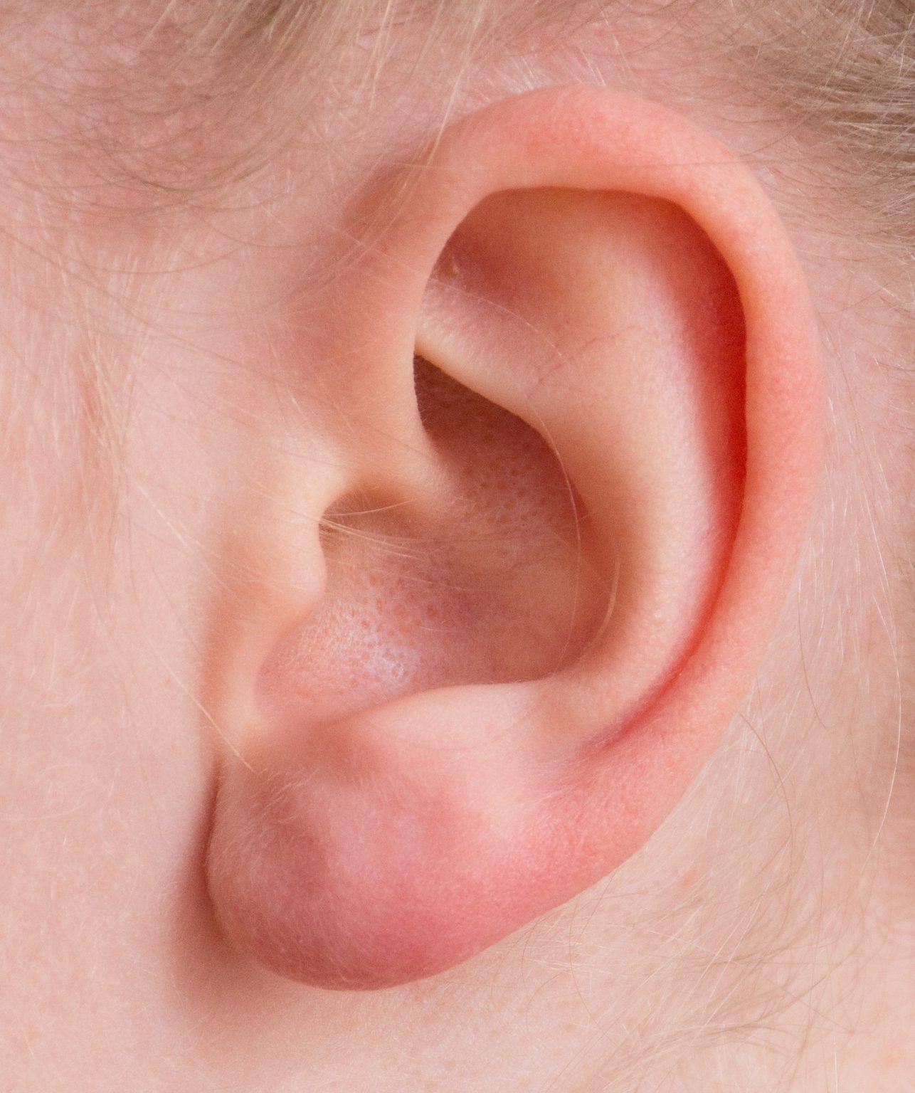 Ear correction - description of older techniques - YUVEO Klinik
