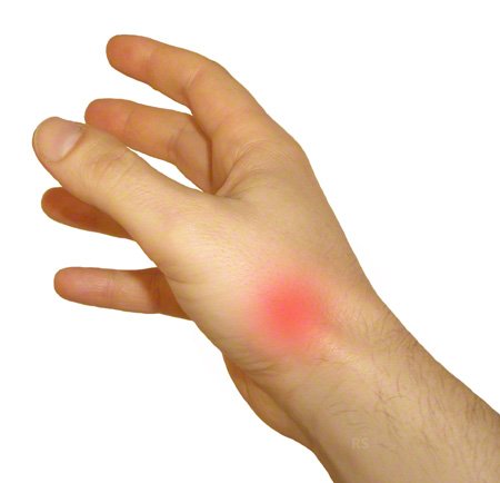 Rhizarthrose Düsseldorf - YUVEO Klinik