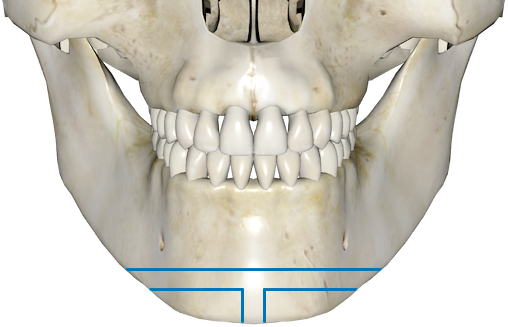 Kinnverkleinerung in Düsseldorf | V-Line-Surgery | YUVEO
